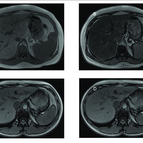 Ct Imaging Features Of Liver Steatosis Caption Transverse Ct Image Download Scientific
