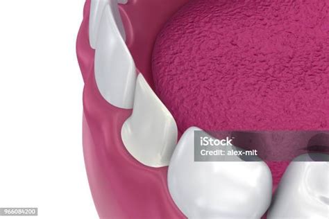 치과 베 니 어판 도자기 한 척 설치 절차입니다 3 차원 일러스트 레이 션 건강관리와 의술에 대한 스톡 사진 및 기타 이미지