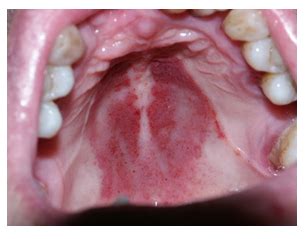 Oral Hematomas Following Oral Sex In Individuals With Disrupted Coagulation