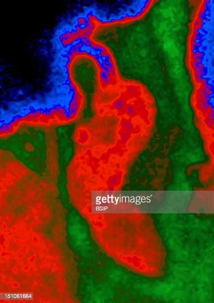 Appendicitis Photos And Premium High Res Pictures Getty Images