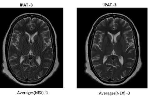 parallel imaging artifact mri parallel imaging artifact