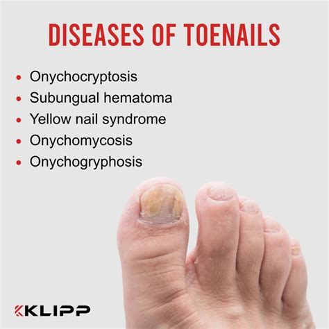 Toenail Problems Can Affect People Of All Ages But Tend To Be More Common In Older People