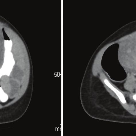 Gastric Gist Tumor A Upper Endoscopy B Tumor Bisected After Excision