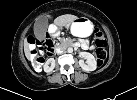 Filepancreatic Adenocarcinoma Double Duct Sign Liver And Cystic