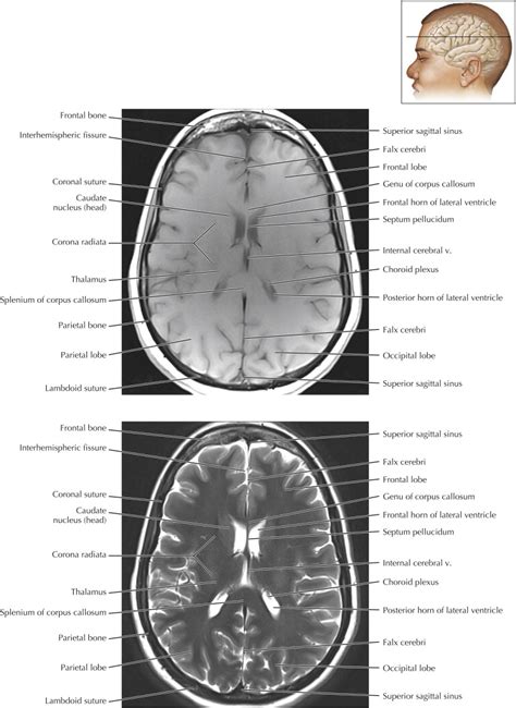 Brain Anatomy On Ct