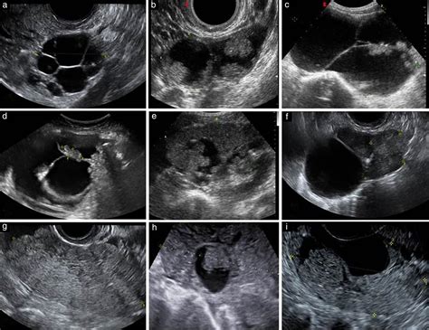 Ovarian Cancer Tumor Ultrasound