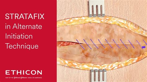 Stratafix Symmetric Pds Plus Alternate Initiation Suturing Technique Jandj Medtech Youtube