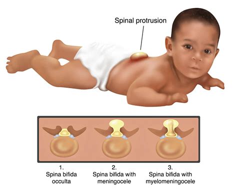 Spina Bifida Diagnostizieren Und Behandeln Medde