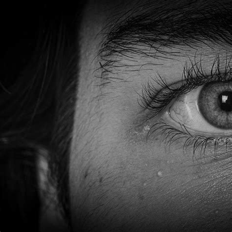 Meibomian Gland Dysfunction Surgery Dry Eye Mgd