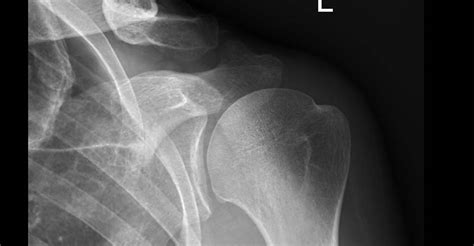 Shoulder Arthritis Dr Doron Sher