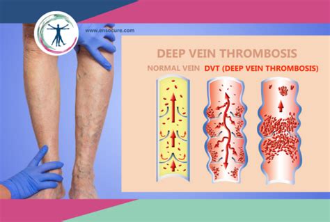 Deep Vein Thrombosis Causes Signs Treatment And Management Ensocure