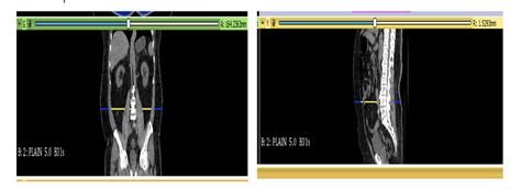3d Slicer Automatically Quantifies Vat And Sat Volumes Download
