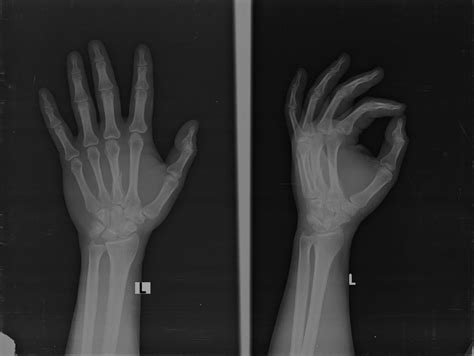 Metacarpal Shaft Fracture