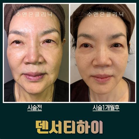 수앤은 매끈한 종아리 얇은 발목 가능합니다 종아리 보톡스 맞고 발목이 두꺼워지거나 종아리가 울퉁불퉁해졌다면 별언니피부상담소애서 원인을 찾고 교정해보새요