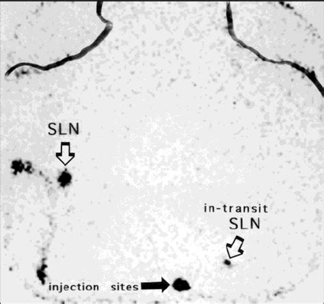 Anterior Chest View Reveals A Right Axillary Sentinel Lymph Node And A Download Scientific