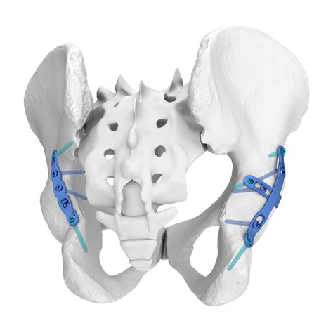 Fap Posterior Column Anatomic Locking Platemedical Device Manufacturers Double Medical