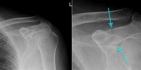 Acromion Fracture Radiology At St Vincents University Hospital