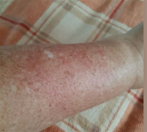 A Simple Burning Rash