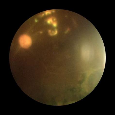 Retina Default Instance Segmentation Dataset By Thastp