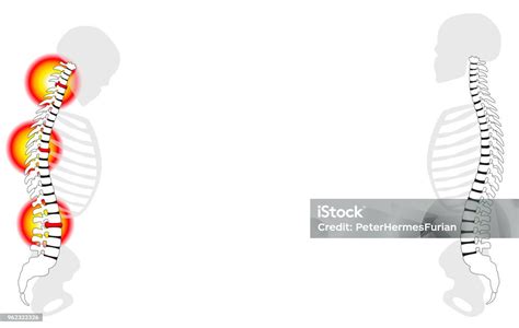 문제 목 통증 심한 통증와 비교흰색 배경에 고립 된 벡터 일러스트 레이 션에에서 건강 한 뒤 다시 곡선 미 끄 러 디스크 Prolapses다시 건강관리와 의술에 대한 스톡