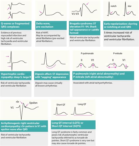 Figure 3 Changes On Resting ECG That May Reveal Cause Of Arrhythmias