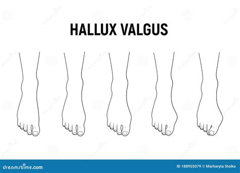 Hallux Valgus Disease Stage Cartoon Vector 188955079