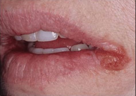 ¿cómo Se Cura La Queilitis Angular ¿cuánto Dura Abaden