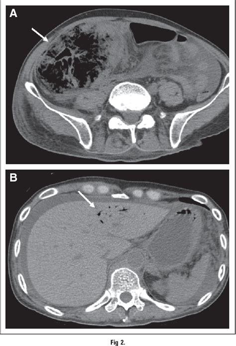 Figure 2 From Emphysematous Colitis Of Ascending Colon With Portal Venous Air Caused By Diffuse