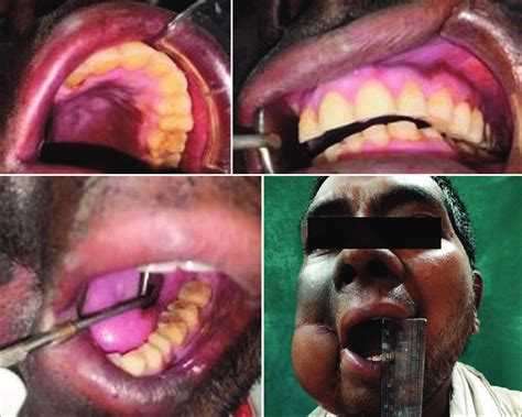 Mandibular Deviation And Maximum Mouth Opening Download Scientific Diagram