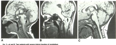 Figure 1 From Mr Imaging Of Chiari Ii Malformation Semantic Scholar