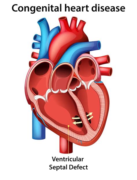 Images De Myocardite Téléchargement Gratuit Sur Freepik