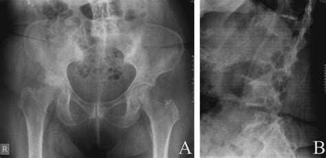 A Radiographic Image Of Sacroiliac Joints With Severe Joint Space