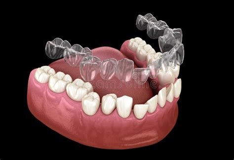 Invisalign Braces Or Invisible Retainer Make Bite Correction Medically Accurate 3d Illustration