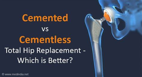 High Fracture Risk After Total Hip Replacement With Cementless Implants