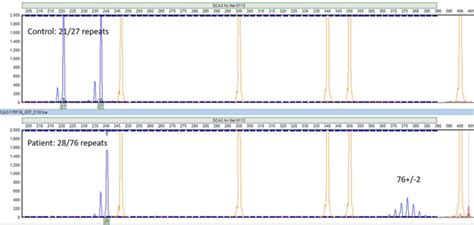 Cag Repeat Analysis Of Patient [iii 13] Of Case 2 Showed One Expanded