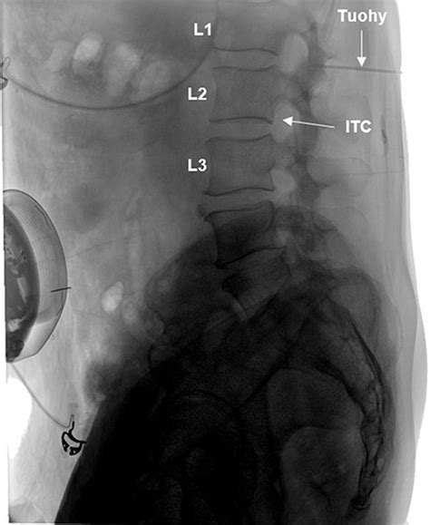 Case Report Portable X Ray Guided Blood Patch Therapy In Post Anesthe
