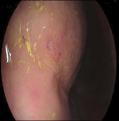 Stomach This Autoimmune Atrophic Pangastritis A Rare Type Of Gastritis Pmc