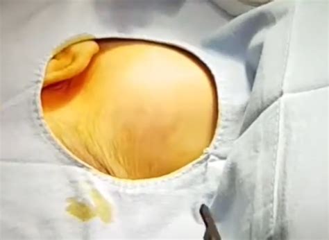 Lymph Node Abscess Treatment Archives New Pimple Popping Videos