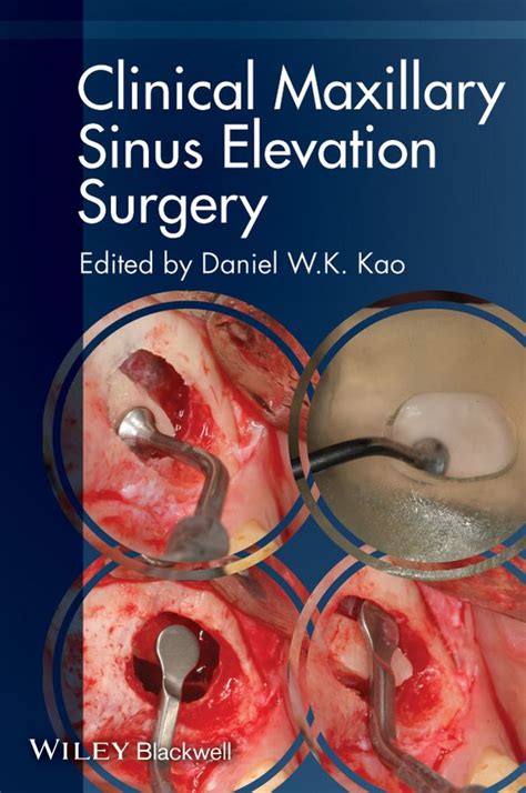 Clinical Maxillary Sinus Elevation Surgery 9780470960738 Gangarams