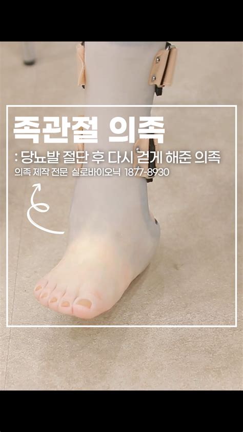고퀄리티 3d 의수족 제작 전문 실로바이오닉 절단 장애인의 가족으로 산다는 것 안녕하세요 실로바이오닉입니다 당뇨로