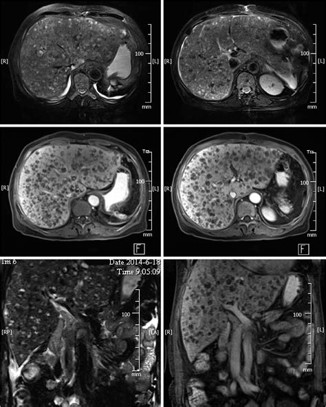 Figure 2 From Case Report Of Primary Splenic Angiosarcoma With Hepatic Metastases Semantic