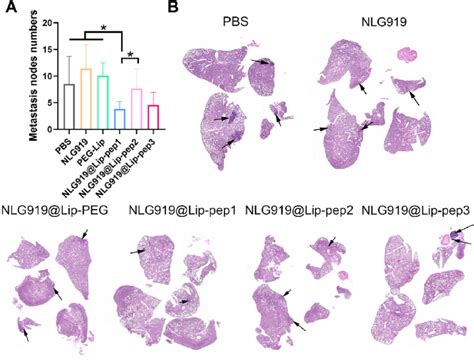 A Number Of Metastatic Nodules On The Lungs N Z 7 P