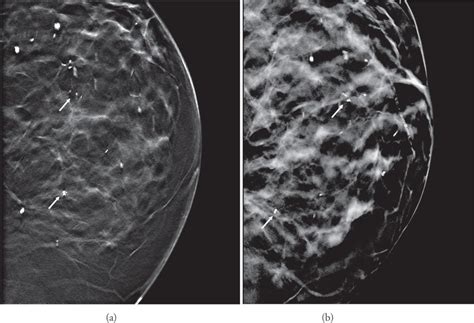 Pbt Image At Z 38 Mm Of A 76 Year Old With Heterogeneously Dense