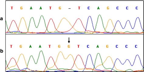 Sequence Analysis Of The Androgen Receptor Gene Mutation Dna Sequence Download Scientific