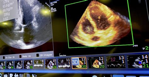 Exploring The Link Between Left Ventricular Diastolic Function And Afib