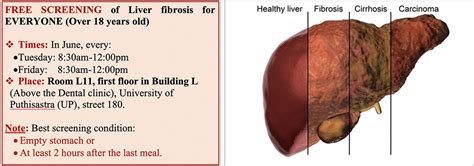 FREE SCREENING For Liver Fibrosis Will Re Start On Tuesday Nd June Welcome To University