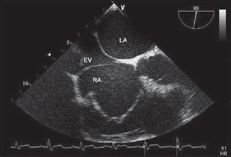Transesophageal Echocardiography Reveals A Long Eustachian Valve Download Scientific Diagram