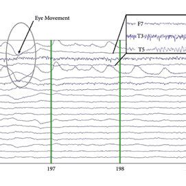 Example Of An EEG Signal Contaminated With Noise Download Scientific Diagram