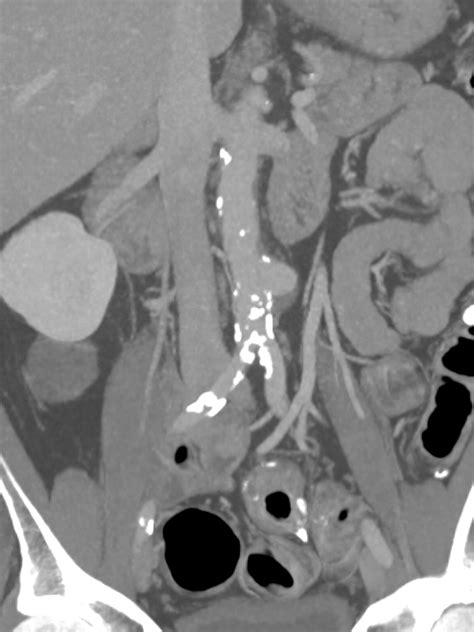 Radiology Wales Saccular Aortic Aneurysm Interventional Radiology