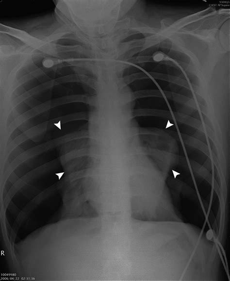 Pneumothorax X Ray